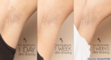 How to Craft Effective Laser Hair Removal Ads for Social Media - Podium